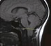 Syringohydromyelia and Syringomyelia Imaging: Practice Essentials ...
