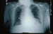 Pediatric Congestive Heart Failure