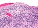 Balanitis Xerotica Obliterans: Background, Pathophysiology, Epidemiology