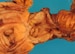 Crohn Disease Pathology
