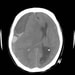 Brain Herniation Imaging: Practice Essentials, Computed Tomography ...