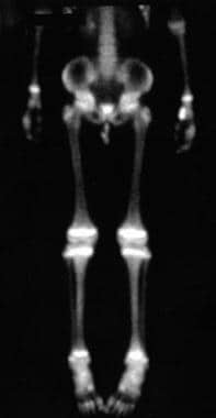 Subacute Osteomyelitis (Brodie Abscess) Workup: Laboratory Studies ...