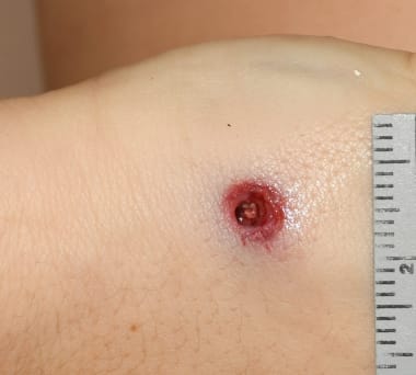 Forensic Pathology Of Firearm Wounds Overview Modern Ammunition