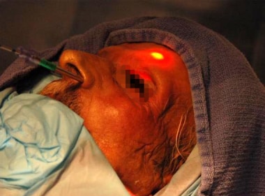 Chronic Sinusitis Treatment & Management: Approach Considerations ...