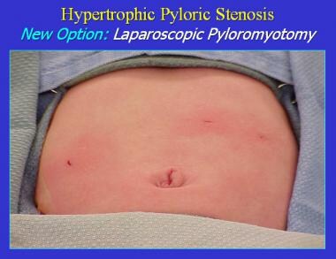 Pediatric Hypertrophic Pyloric Stenosis Surgery Workup: Laboratory ...