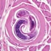 Trichinosis (Trichinellosis) Workup: Approach Considerations ...