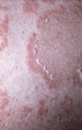 Autoimmune Progesterone Dermatitis