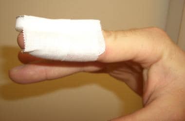 Extensor Tendon Repair Technique: Approach Considerations, General ...