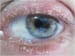 Xdemvy (lotilaner ophthalmic) dosing, indications, interactions ...