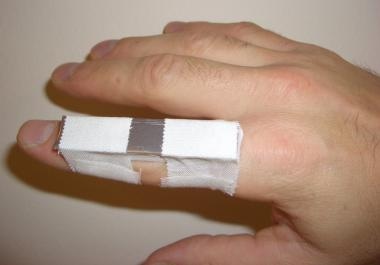 Extensor Tendon Injury Splint