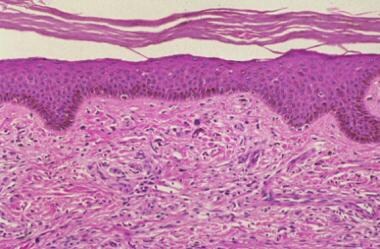 Dermatologic Manifestations of Filariasis: Overview, Onchocerciasis ...