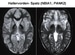 Pantothenate Kinase-Associated Neurodegeneration (PKAN): Background ...
