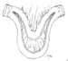 Augmentation Cystoplasty Technique: Approach Considerations, Bladder ...