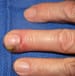 Digital Mucous Cyst: Background, Pathophysiology, Etiology