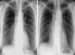 Bronchiectasis Imaging: Overview, Radiography, Computed Tomography