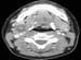 Branchial Cleft Cyst: Background, Pathophysiology, Etiology
