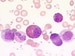 Chronic Myelogenous Leukemia (CML)