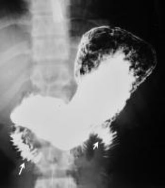 Zollinger-Ellison Syndrome Imaging: Overview, Radiography, Computed ...