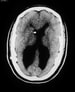 Is CT Imaging Useful in the Evaluation of Vertigo in the ED? - Page 4