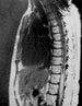 Syringomyelia Clinical Presentation: History, Physical Examination