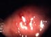Proctitis and Anusitis Workup: Laboratory Studies, Imaging Studies ...