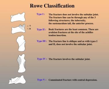 Calcaneus Fracture Imaging: Overview, Radiography, Computed Tomography