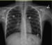 Right Middle Lobe Syndrome: Practice Essentials, Pathophysiology, Etiology