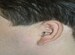 Preauricular Skin Tags or Ear Pits and Hearing Impairment