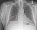 Idiopathic Pulmonary Fibrosis (IPF) Workup: Laboratory Studies, Imaging ...