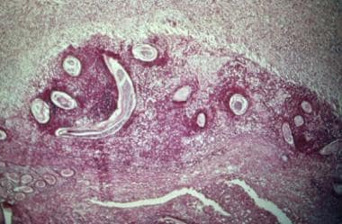 Dermatologic Manifestations of Filariasis: Overview, Onchocerciasis ...