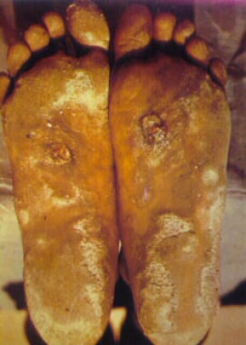 Syphilis and Treponematosis Clinical Presentation: History, Physical ...