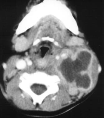 Deep Neck Infections Workup: Laboratory Studies, Imaging Studies