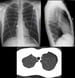Pneumothorax Imaging: Practice Essentials, Radiography, Computed Tomography