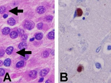 Neuropathology Of Picks Disease Pick Bodies Arrows In 8 ...