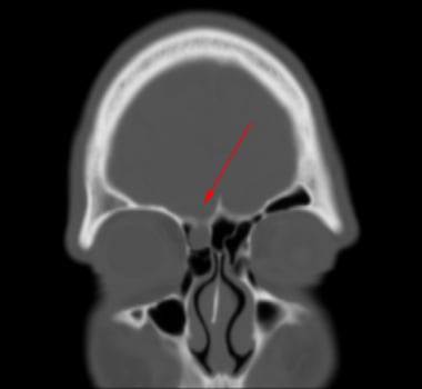 CSF Rhinorrhea Workup: Approach Considerations, Laboratory Studies ...