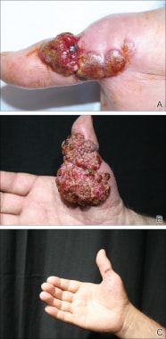 Orf Treatment & Management: Medical Care, Surgical Care, Prevention