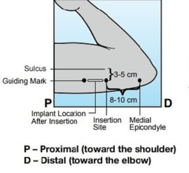 Contraceptive Implant Placement Periprocedural Care: Patient Education ...