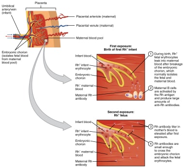Rh Incompatibility: Background, Etiology, Pathophysiology