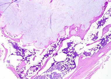 Enchondroma Pathology: Definition, Epidemiology, Etiology