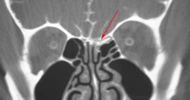 CSF Rhinorrhea Workup: Approach Considerations, Laboratory Studies ...