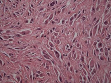 Pathology of Spitz Nevi: Overview, Pathophysiology and Etiology ...