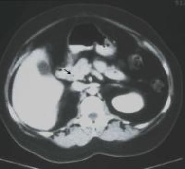 Zollinger-Ellison Syndrome Workup: Approach Considerations, Laboratory ...