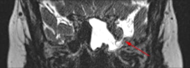 CSF Rhinorrhea Workup: Approach Considerations, Laboratory Studies ...