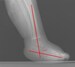 Clubfoot Imaging: Practice Essentials, Radiography, Computed Tomography