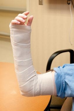 Sugar-Tong Forearm Splinting: Overview, Indications, Contraindications