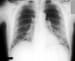 Farmer's Lung Workup: Approach Considerations, Laboratory Studies ...