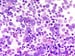 Polycythemia Vera Workup: Approach Considerations, Laboratory Studies ...