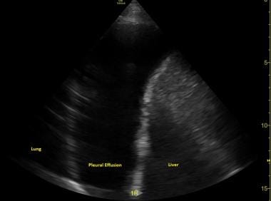 Pleural Effusion Workup: Approach Considerations, Chest Radiography ...