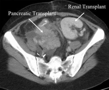 Imaging in Kidney Transplantation Complications: Overview, Radiography ...