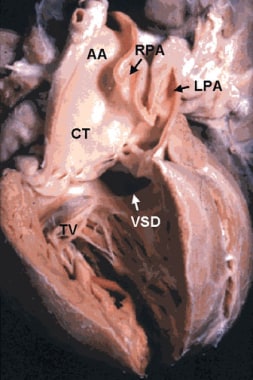 Truncus Arteriosus